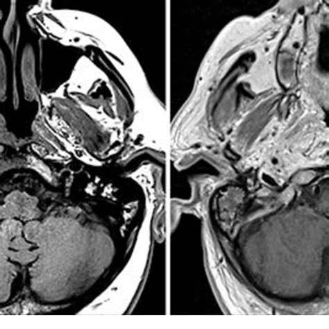 Case 1 Axial Pre Gadolinium A And Post Gadolinium B Images Show