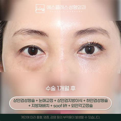 에스클래스에서 실제로 눈 성형 을 진행한 고객님의 전후1개월 경과사진입니다 👉수술 내용 상안검성형술눈매교정상안검지방이식하안검성형술지방재배치soof