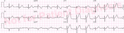 An Obvious Lad Occlusion That Did Not Meet Stemi Criteria Dr Smiths Ecg Blog