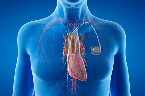 Pacemaker For Heart Rhythm Disorders Types Uses And Benefits