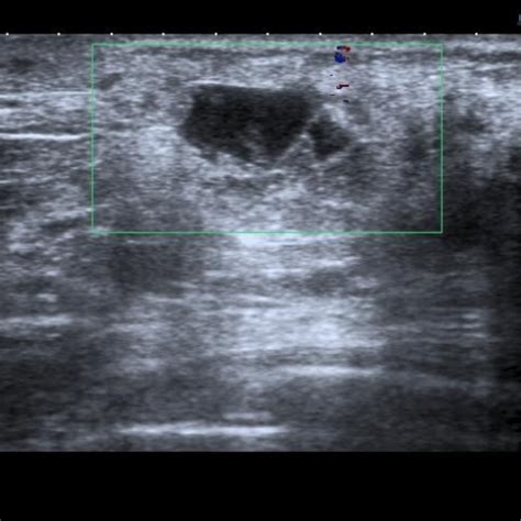Fat Necrosis Breast Ultrasound