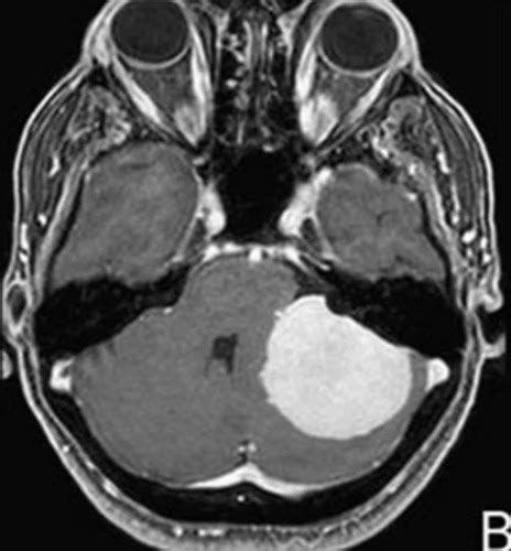 Disorders Of Motor Control Flashcards Quizlet