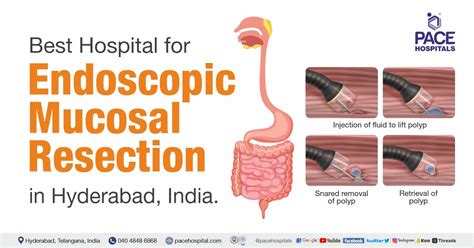 Endoscopic Mucosal Resection In Hyderabad India Indications And Cost