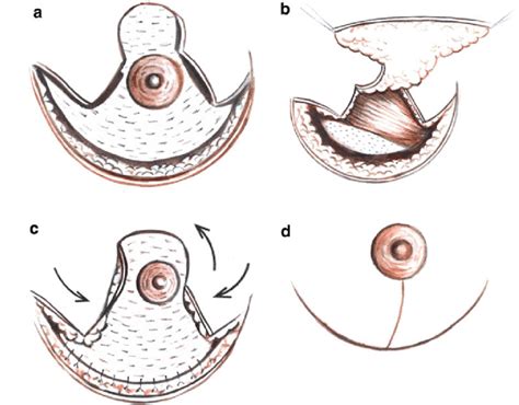 A Diagram Of The Flap After Deepithelialization B Diagram Of The