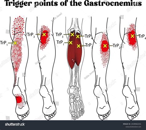 Trigger Points Diagram Trigger Points Gastrocnemius Stock Vector Royalty Free 2539562231