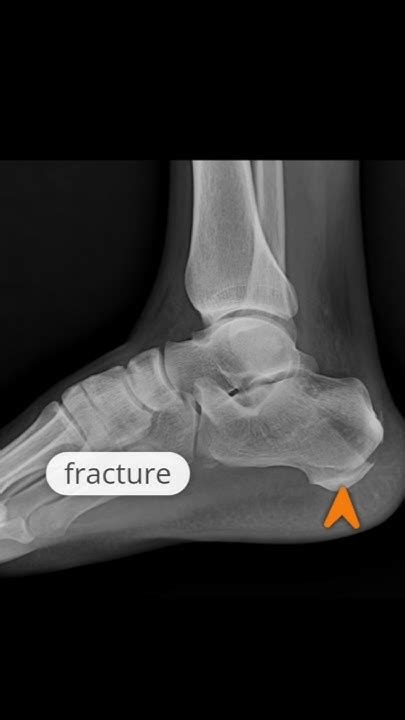A Transverse Incomplete Non Displaced Fracture Of The Calcaneus Xray