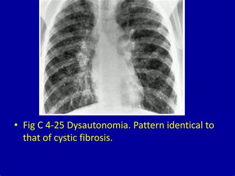 4 Diffuse Reticular Or Reticulonodular Pattern Pptx