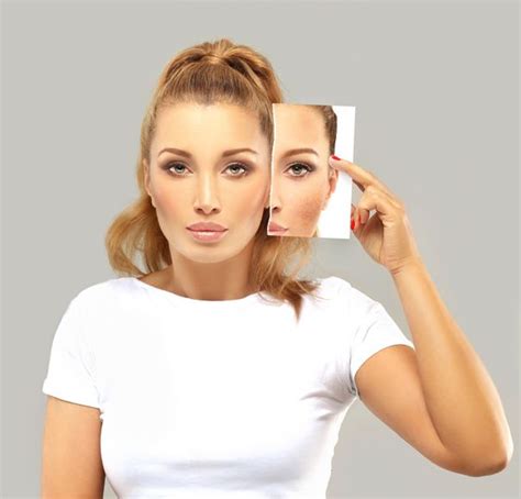 What Are The Best Treatments For Hyperpigmentation Scars New Beauty