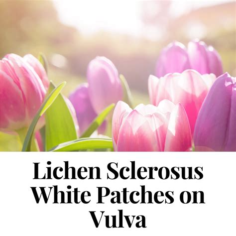 Lichen Sclerosus White Patches On Vulva Symptoms And Private Treatment