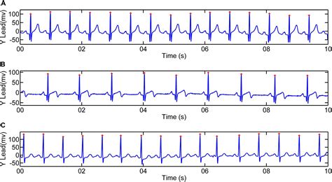 Frontiers R Wave Singularity A New Morphological Approach To The
