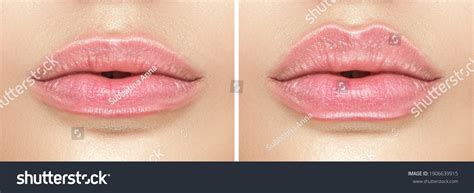 Before After Lip Filler Injections Fillers Stock Photo Shutterstock