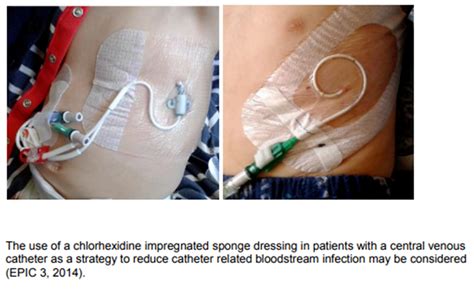 Central Venous Lines And Their Problems Extrinsic Modifiable Risk