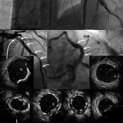 Images A B Significant Stenosis In Proximal Segment Of The Left Download Scientific Diagram