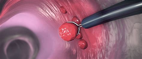 What Is A Polypectomy Gastroenterologist In Cape Town Dr Deetlefs