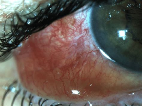 The Patient Presenting With Recurrent Diffuse Scleritis Attacks First
