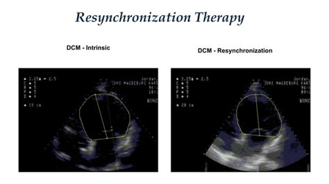 Review Of Conduction System Pacing Pptx
