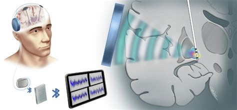 Focused Ultrasound Neuromodulation Clinical Trial Target Engagement Specificity Measured With