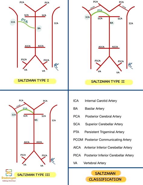 Persistent Trigeminal Artery Radiology Case