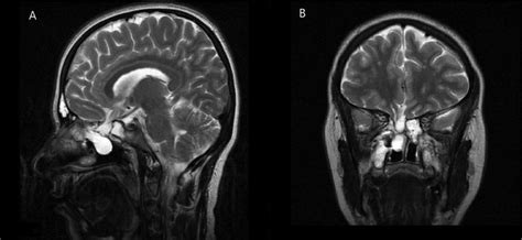 Evidence Of Small Defect Is Seen In Cribriform Plate In Midline With