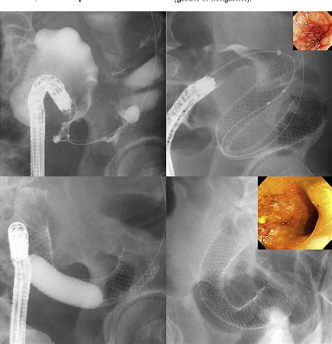 Figure 1 From Palliative Self Expandable Metallic Stent Placement For