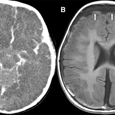 A Brain Ct At Admission Showed Hypoxic Ischemic Encephalopathy With Download Scientific