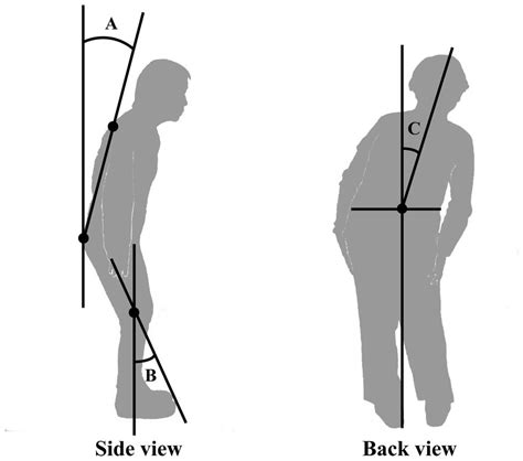 Measurements Of Postural Abnormality In Pd Evaluations Of Bent Spine
