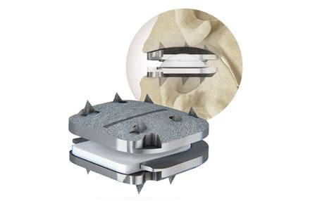 Centinel Spine® Announces First Commercial Use Of The Prodisc® C Vivo