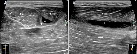 Hamstring Ultrasound Protocol At Jenenge Blog