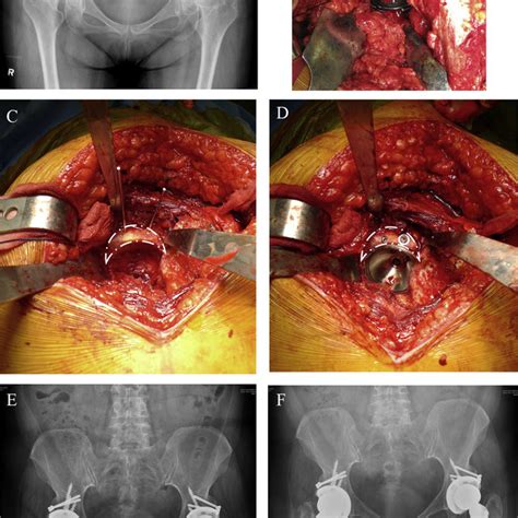 Aaos Classification Of Acetabular Bone Loss Download Table