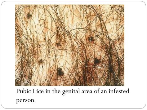 Ppt Pubic Lice Whats Living In Youre Genitals Powerpoint