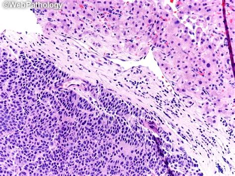 Metastatic Neuroendocrine Tumor