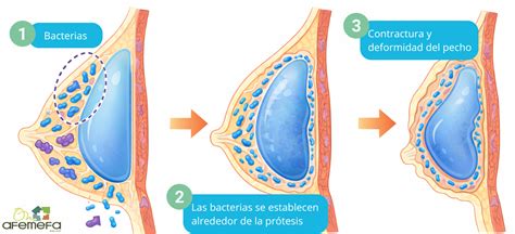 Contractura Capsular Síntomas Riesgos Y Tratamiento
