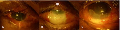 A Lid Margin Hyperemia With Singeing Of Eyelashes B Ischemia Of