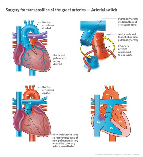 Cardiology Transposition Of The Great Arteries