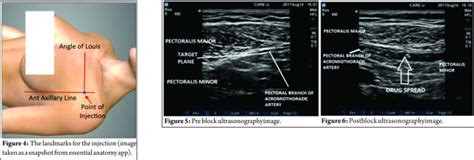 Peripheral Nerve Stimulator Guided Pectoralis Pec I Block A Novel Approach To The Chest Wall