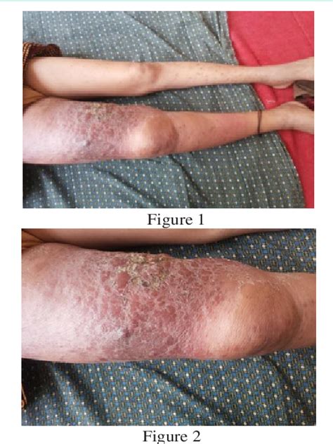 Figure 2 From Primary Cutaneous Diffuse Large B Cell Lymphoma Leg Type