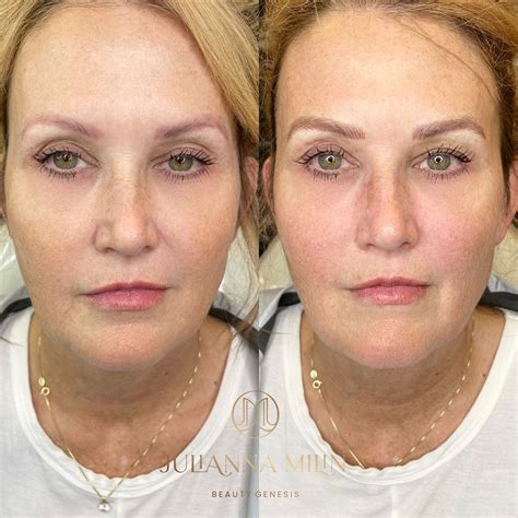 Nano Brows Machine Hairstrokes Hyper Realistic Eyebrow Tattoo