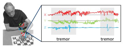Depiction Of Automated Tremor Detection With Wearable Sensors During