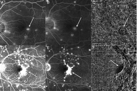 Octa Proves Valuable In Detecting Choroidal Neovascularization In Uveitis