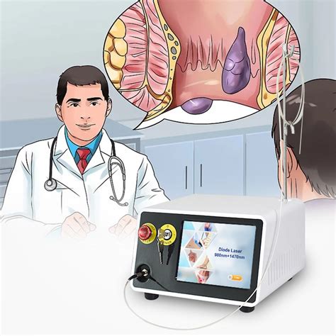 Hemorrhoidectomy Medical Surgery Laser 980nm 1470nm Hemorrhoids