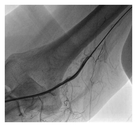 A Radial Angiogram Demonstrating Occlusive Radial Spasm B Radial