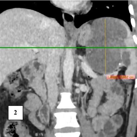 Plain Axial Ct Of The Cyst Showing Areas Of Relative Hyperdensity And