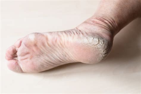 How To Get Rid Of Calluses Foot And Ankle Podiatrists