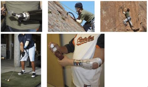 Terminal Devices Highlighted In The Jhss Article On Prosthesis