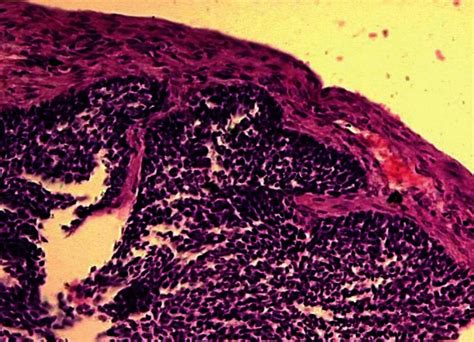 Islands Of Basaloid Cells With Peripheral Palisading Along With Fibrous Download Scientific