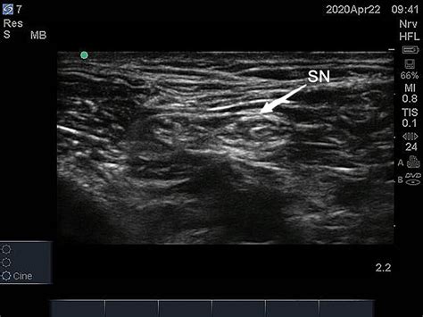Sciatic Nerve Image Under Ultrasound Scan SN Sciatic Nerve Download Scientific Diagram