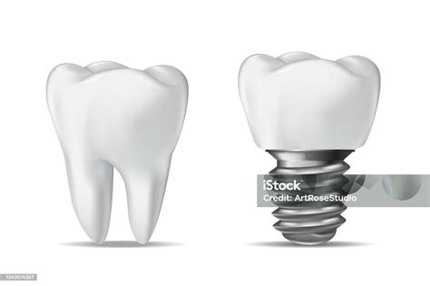 인간의 치아 와 치과 임플란트 치과 개념 사실적인 벡터 일러스트 이빨에 대한 스톡 벡터 아트 및 기타 이미지 이빨 3차원 형태 치과 장비 Istock