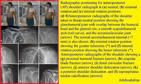 Internal Rotation Shoulder Xray
