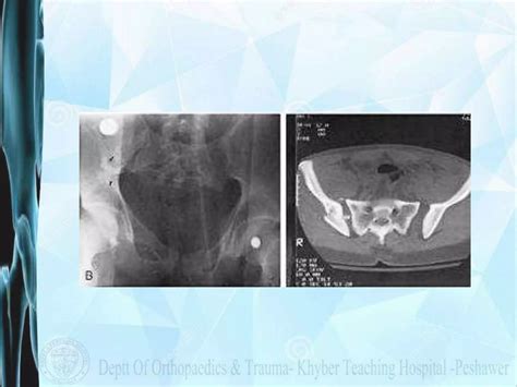 Pelvic Fracture Classification Ppt