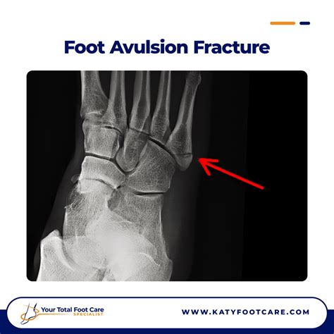 Foot Avulsion Fractures Causes Symptoms And Treatment Ytfcs